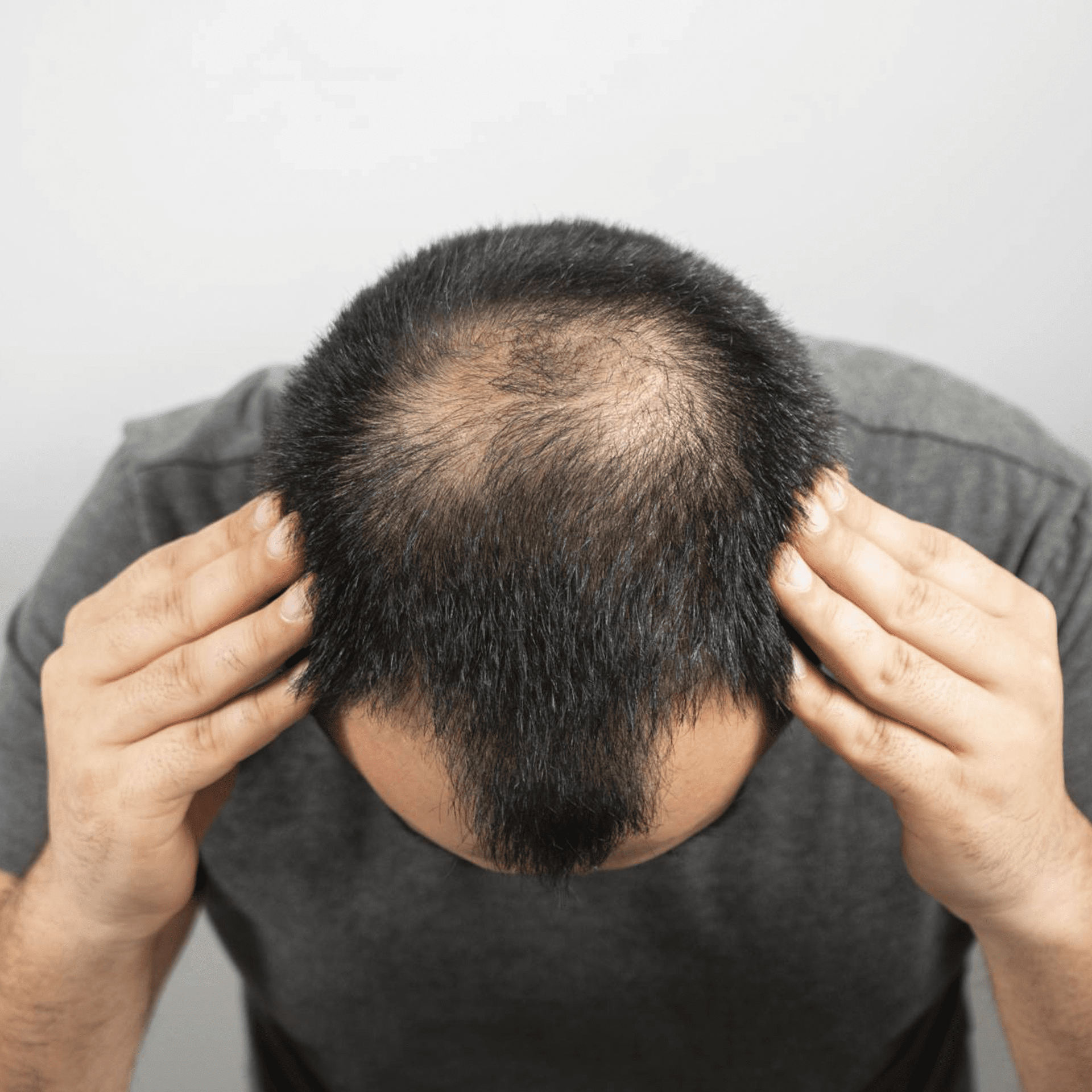 How To Regrow Hair Without Surgery – Dr. Rashmi Aderao Skin, Hair ...