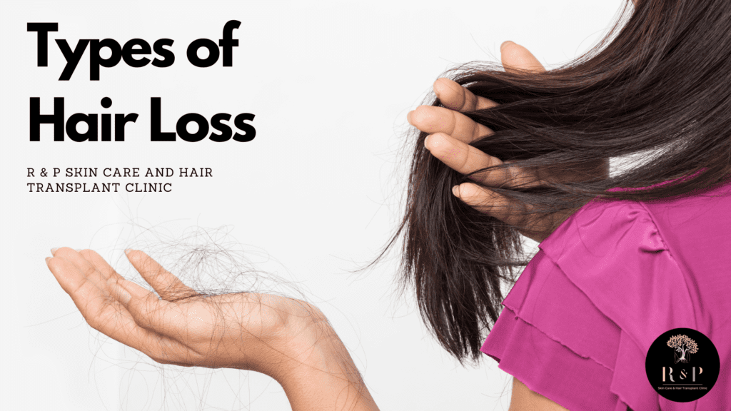 What are the types of Hair Loss? - Dr. Rashmi Aderao Skin, Hair & Laser ...