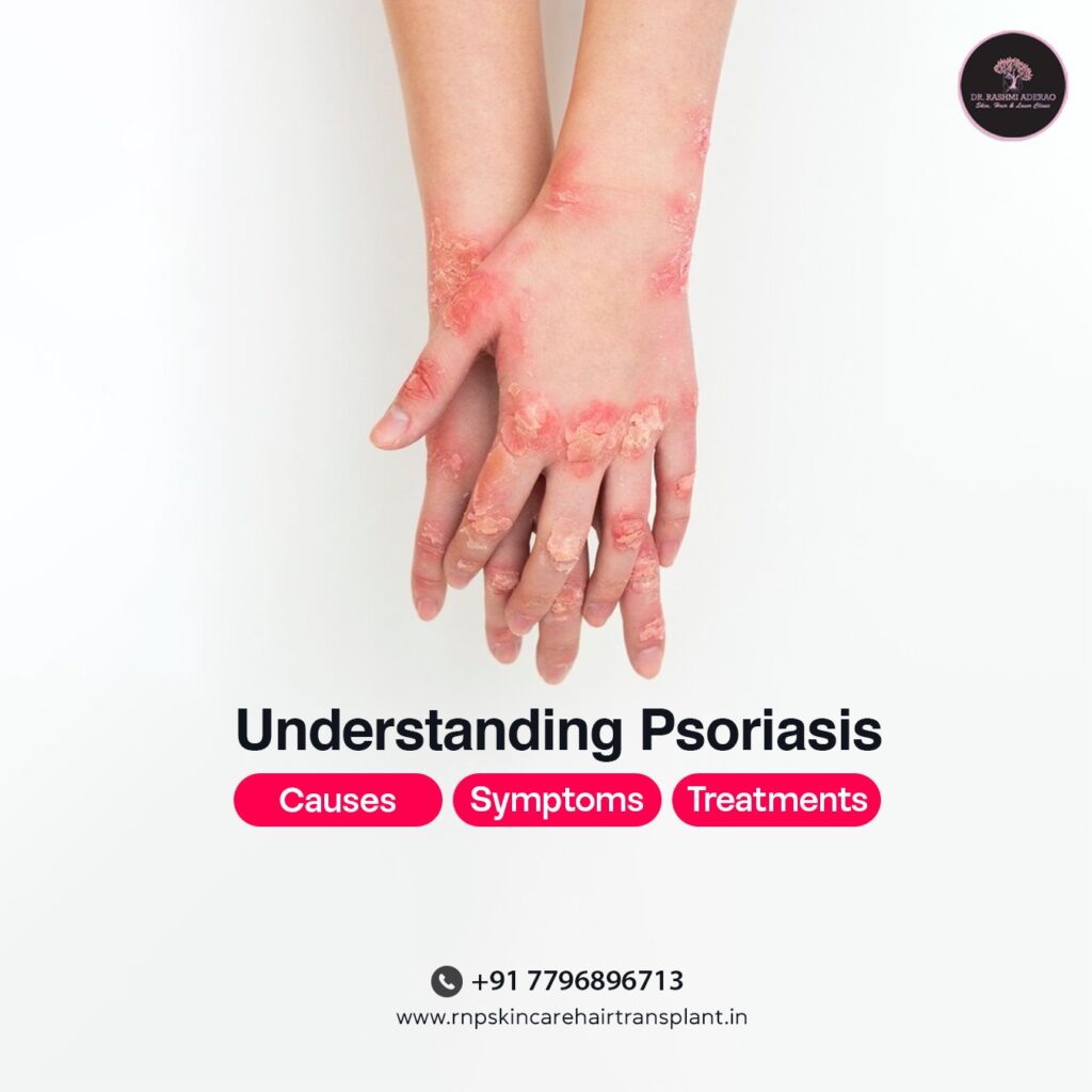 Understanding Psoriasis: Causes, Symptoms, and Treatment - Dr. Rashmi ...