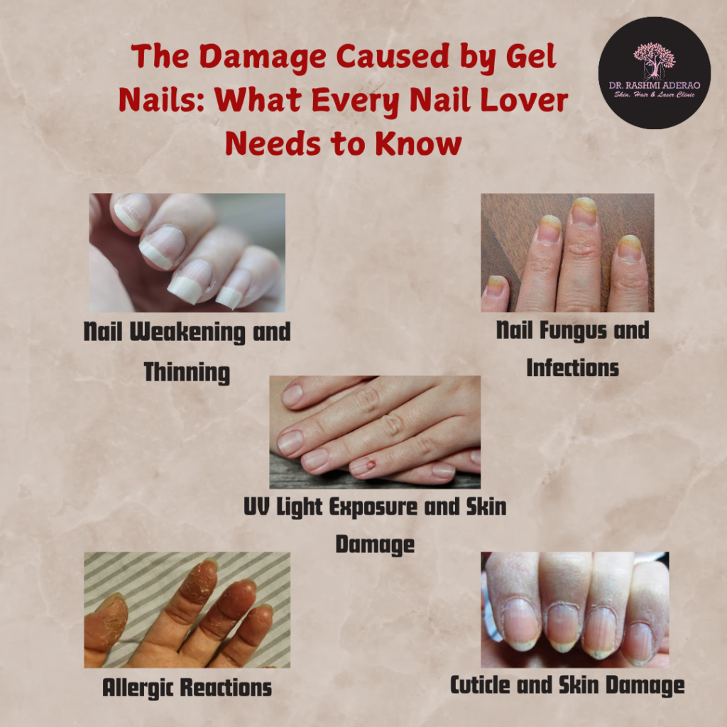 The Damage Caused by Gel Nails: What Every Nail Lover Needs to Know ...